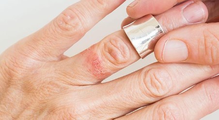 Wat is eczeem (atopische dermatitis)? Symptomen, Oorzaken, Diagnose ...