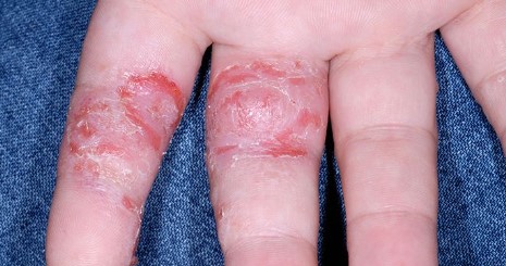 Wat is eczeem (atopische dermatitis)? Symptomen, Oorzaken, Diagnose ...