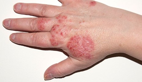 Wat is eczeem (atopische dermatitis)? Symptomen, Oorzaken, Diagnose ...
